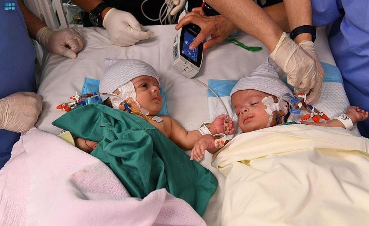 Yemeni conjoined twins “Salman and Abdullah” successfully separated